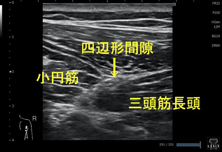 肩痛 （腋窩神経） | 愛知県岡崎市 整形外科,リウマチ科,エコーガイド下筋膜リリース ませぎ整形外科